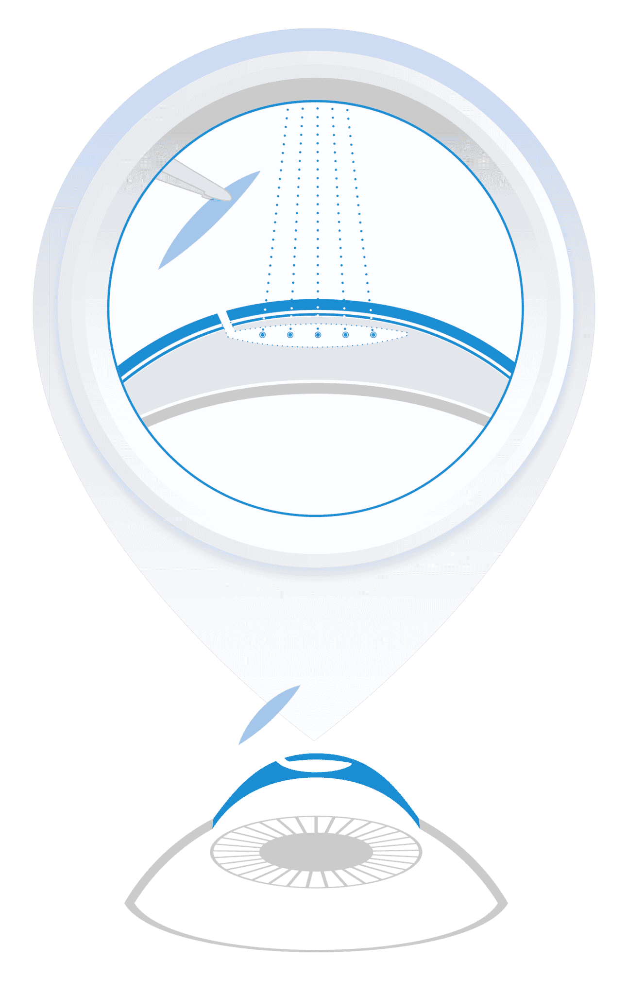 Compare SMILE, LASIK & PRK Eye Surgery | Clear Choice LASIK