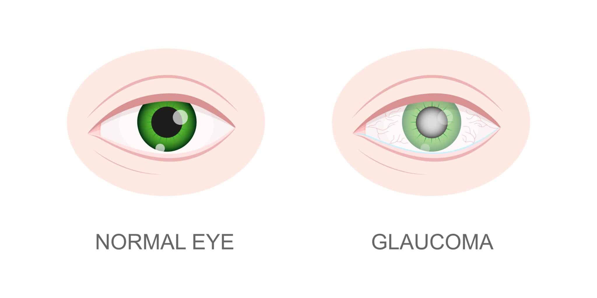 Early Signs of Glaucoma: Symptoms & Causes